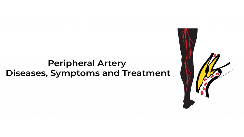 Peripheral Artery Diseases: Symptom &Treatment ~Statcardiologist