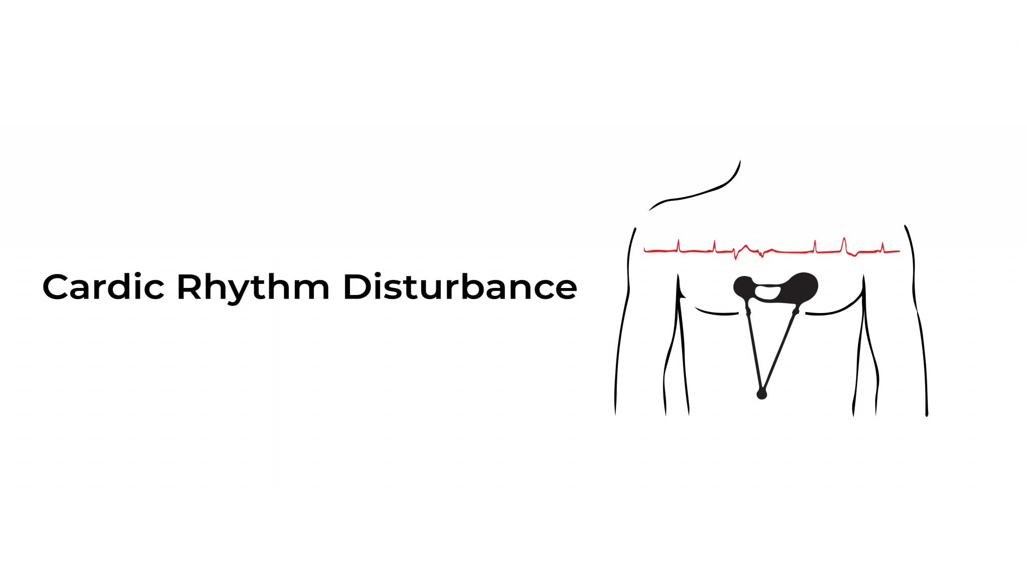 Cardiac Rhythm Disturbance ~ Statcardiologist
