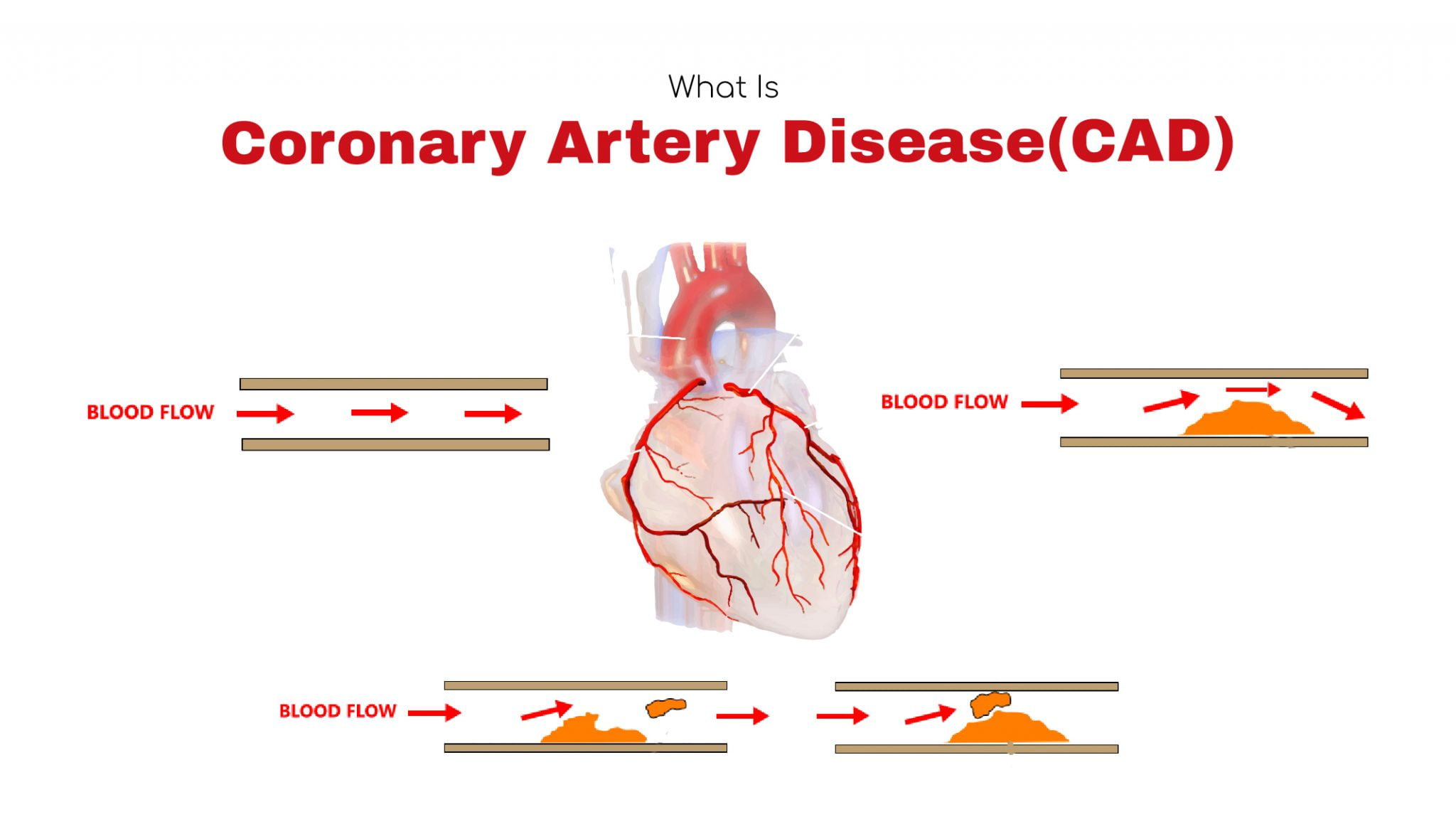 What Is Coronary Artery Disease (CAD)? ~ Statcardiologist