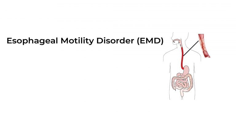Esophageal Motility Disorder (EMD) ~ Statcardiologist