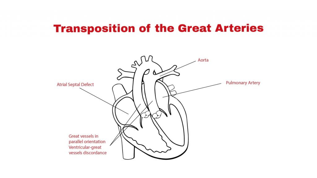 Transposition of the Great Arteries ~ Statcardiologist
