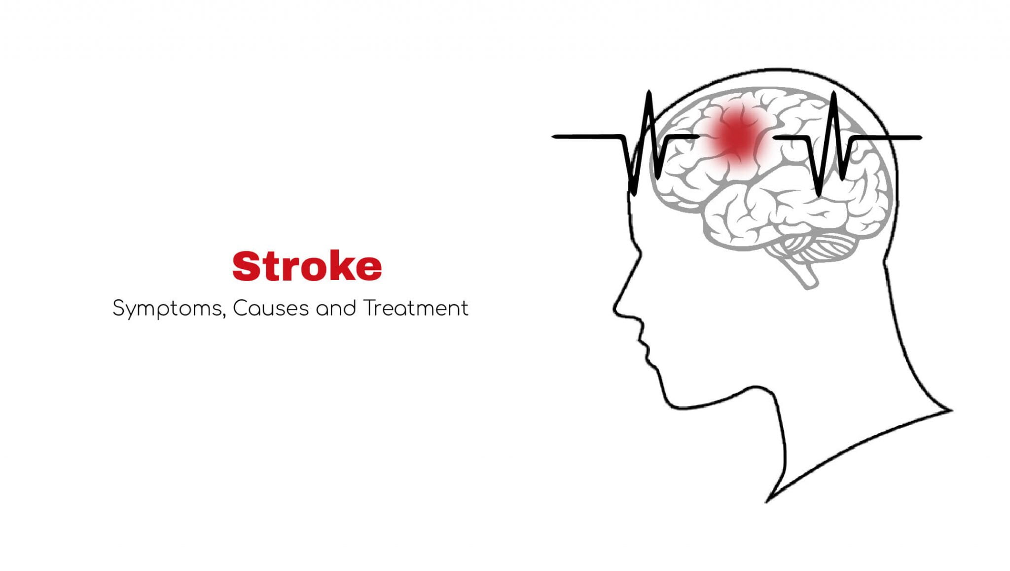 Stroke Symptoms Causes And Treatment Statcardiologist stroke-symptoms-causes-and-treatment-statcardiologist