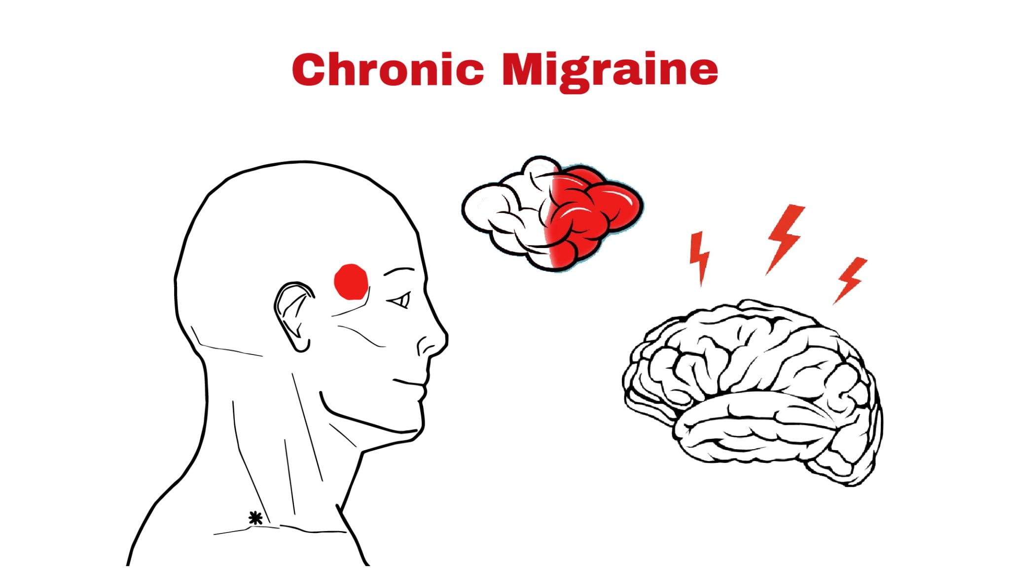 Causes of Chronic Migraine ~ Statcardiologist