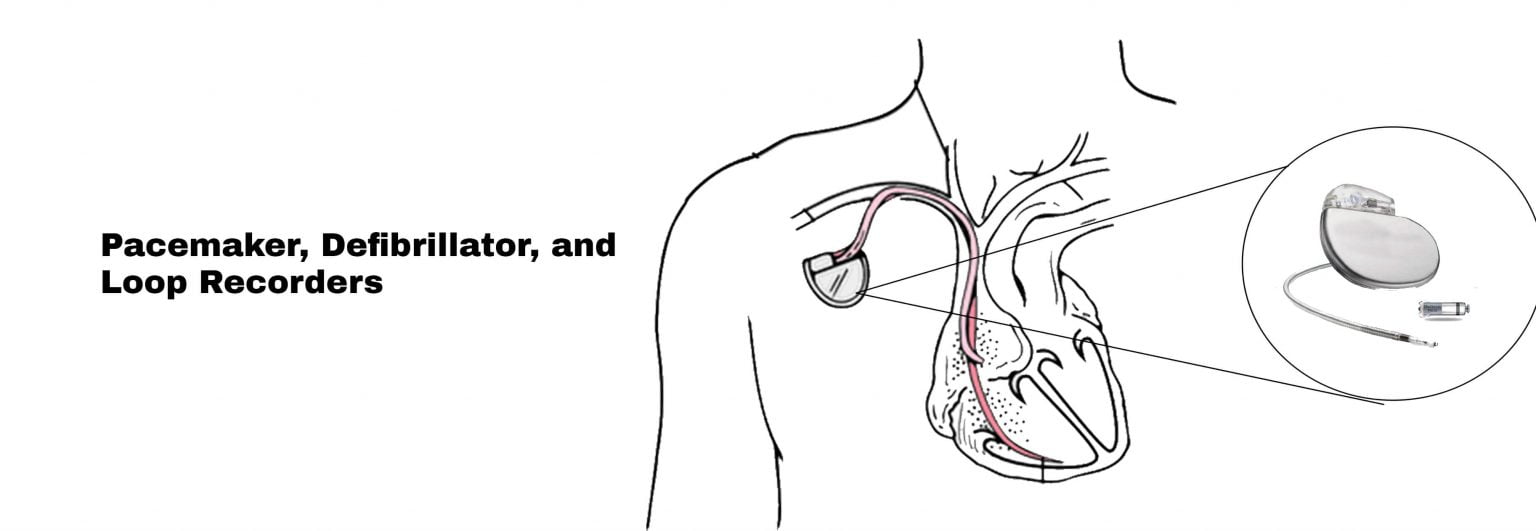 Pacemaker, Defibrillator and Loop Recorders ~ Statcardiologist
