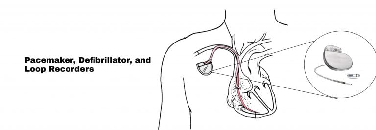 Pacemaker, Defibrillator and Loop Recorders ~ Statcardiologist