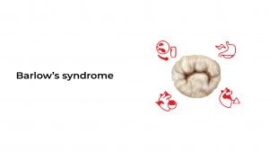 Barlow’s syndrome ~ Stat Cardiologist
