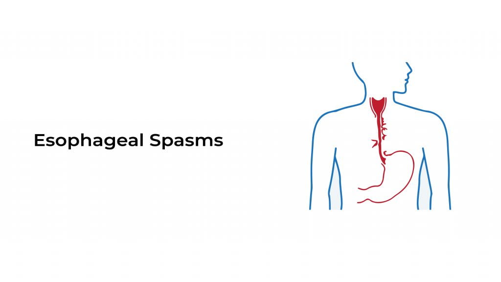 Esophageal Spasms ~ Stat Cardiologist