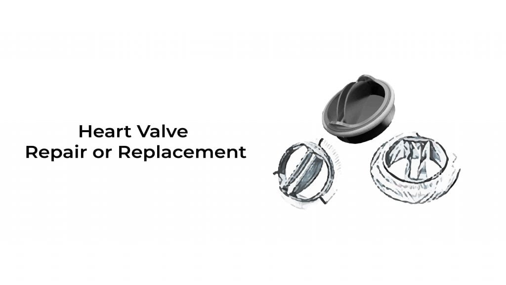 Heart Valve: Repair or Replacement ~ Stat Cardiologist