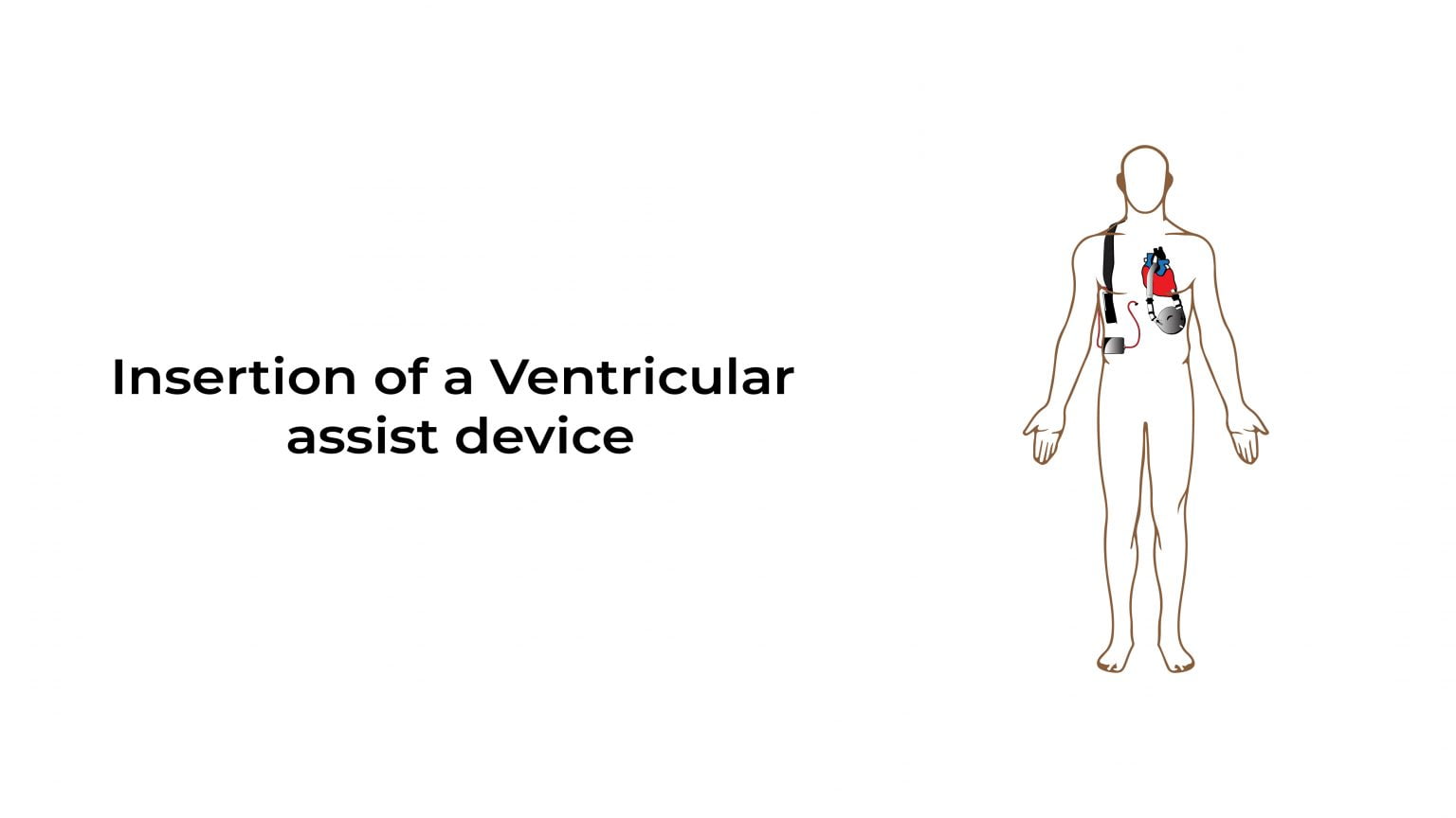 Insertion of a Ventricular assist device ~ Stat Cardiologist