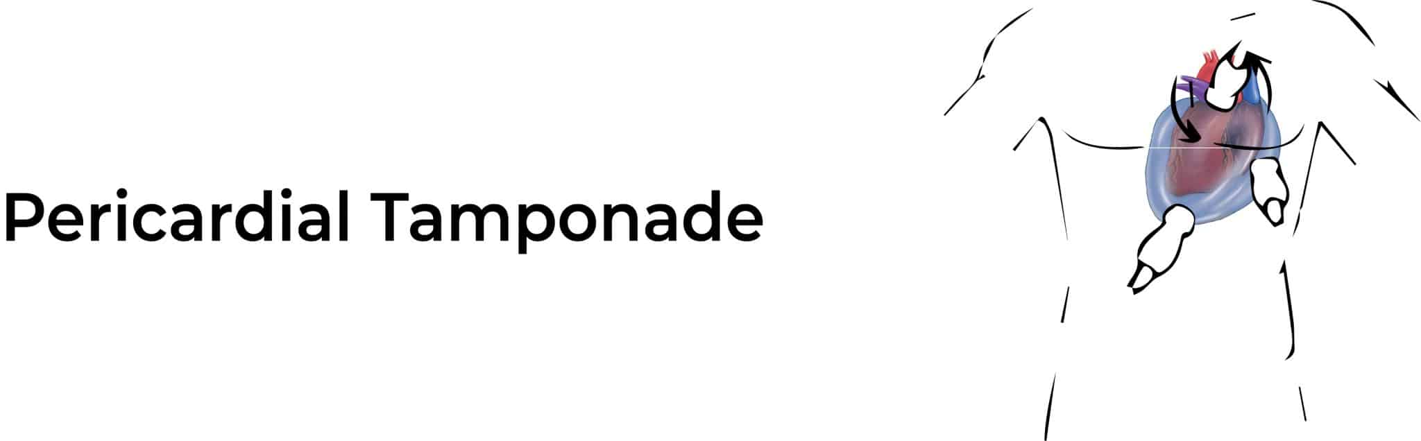 Pericardial Tamponade ~ Stat Cardiologist