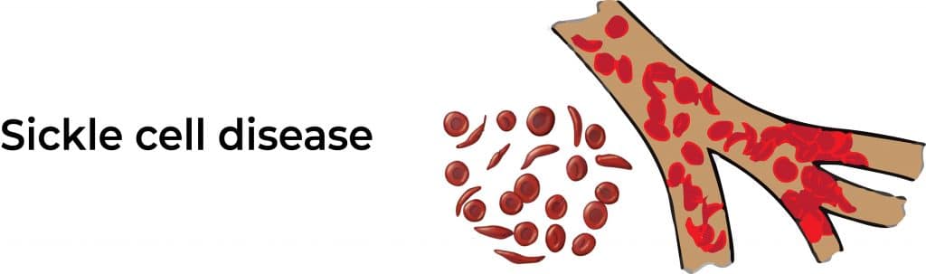 Sickle Cell Disease: Symptoms and Treatment ~ Stat Cardiologist
