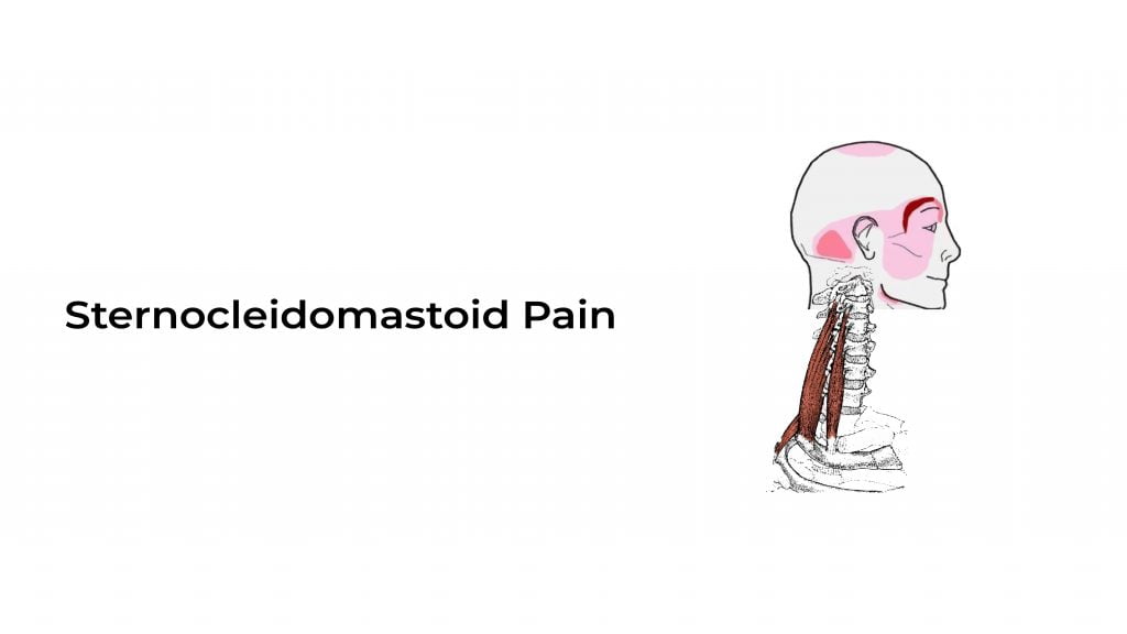 Sternocleidomastoid Pain ~ Stat Cardiologist