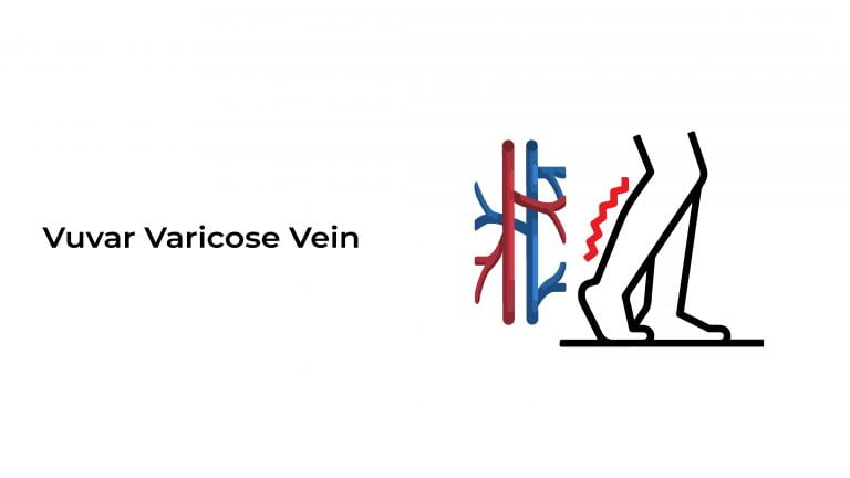 Vulvar Varicose Vein ~ Stat Cardiologist