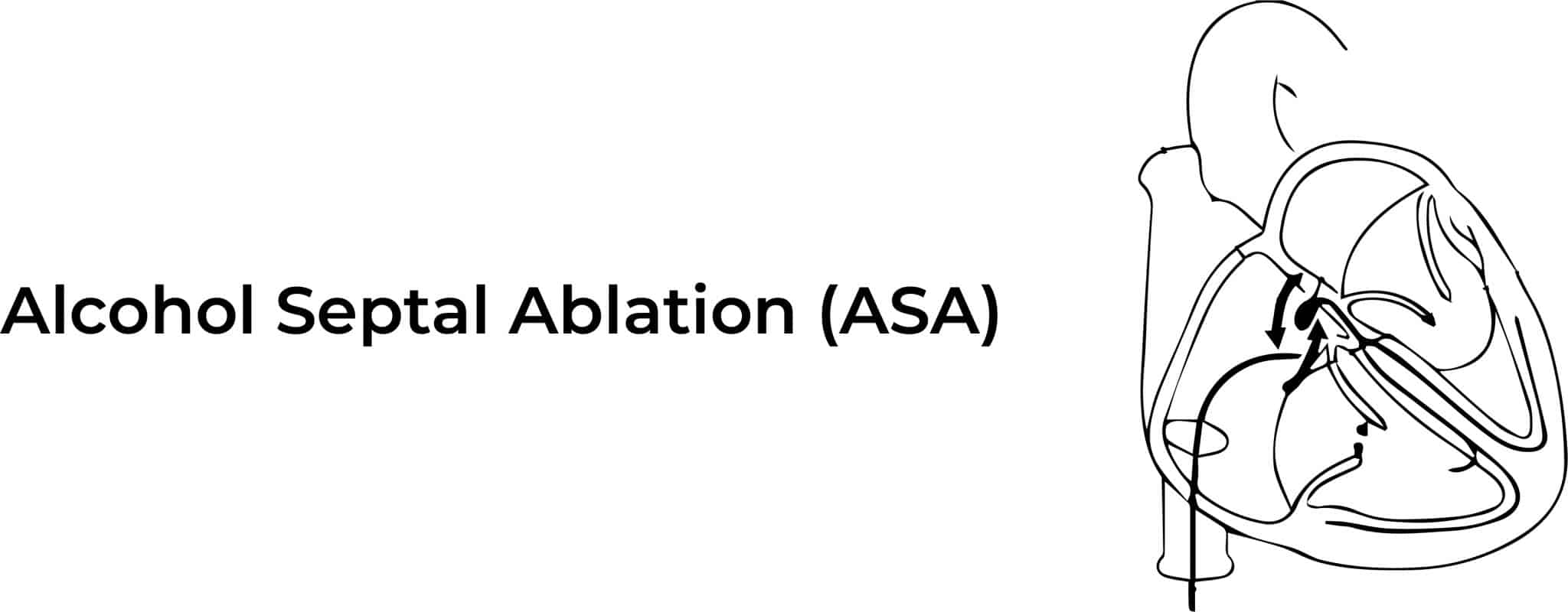 Alcohol Septal Ablation (ASA)~ Statcardiologist