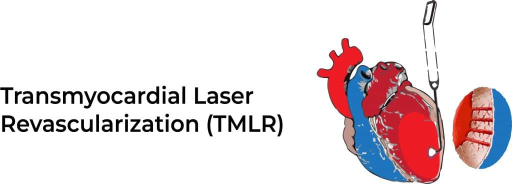 Transmyocardial Laser Revascularization (TMLR) ~ Statcardiologist