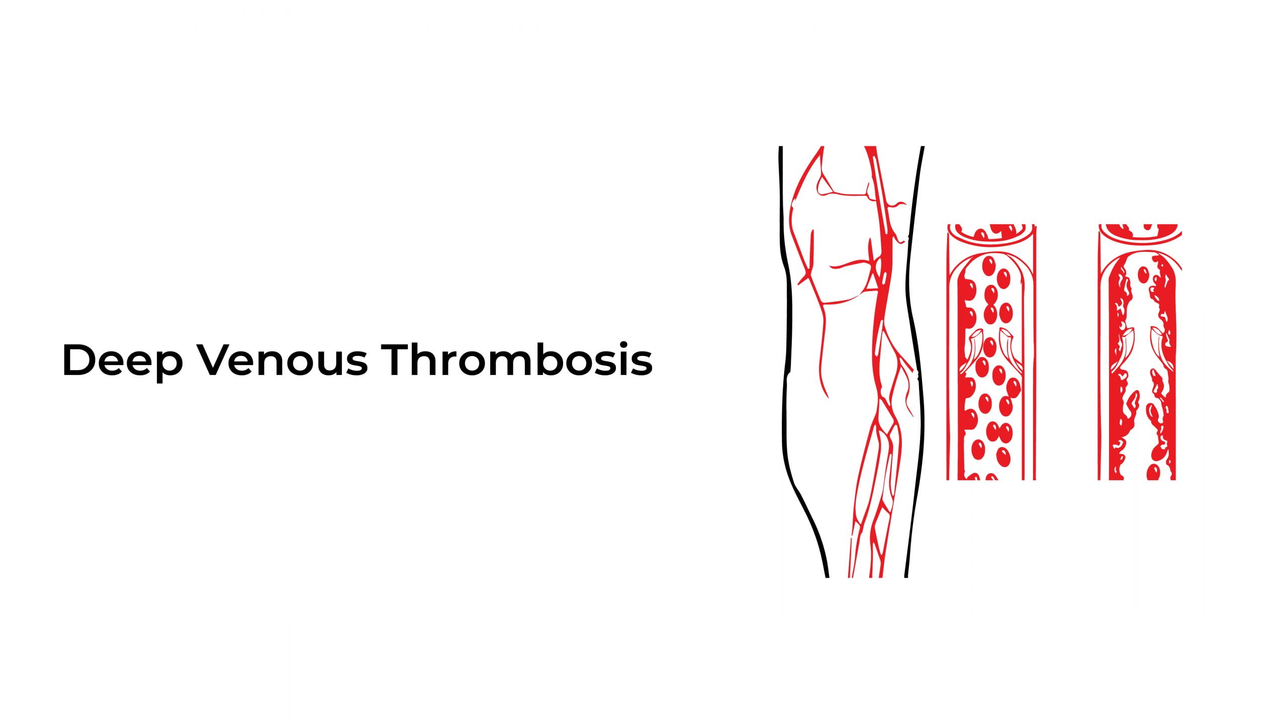Deep Venous Thrombosis (DVTs): A Blood Clot in your leg or arm