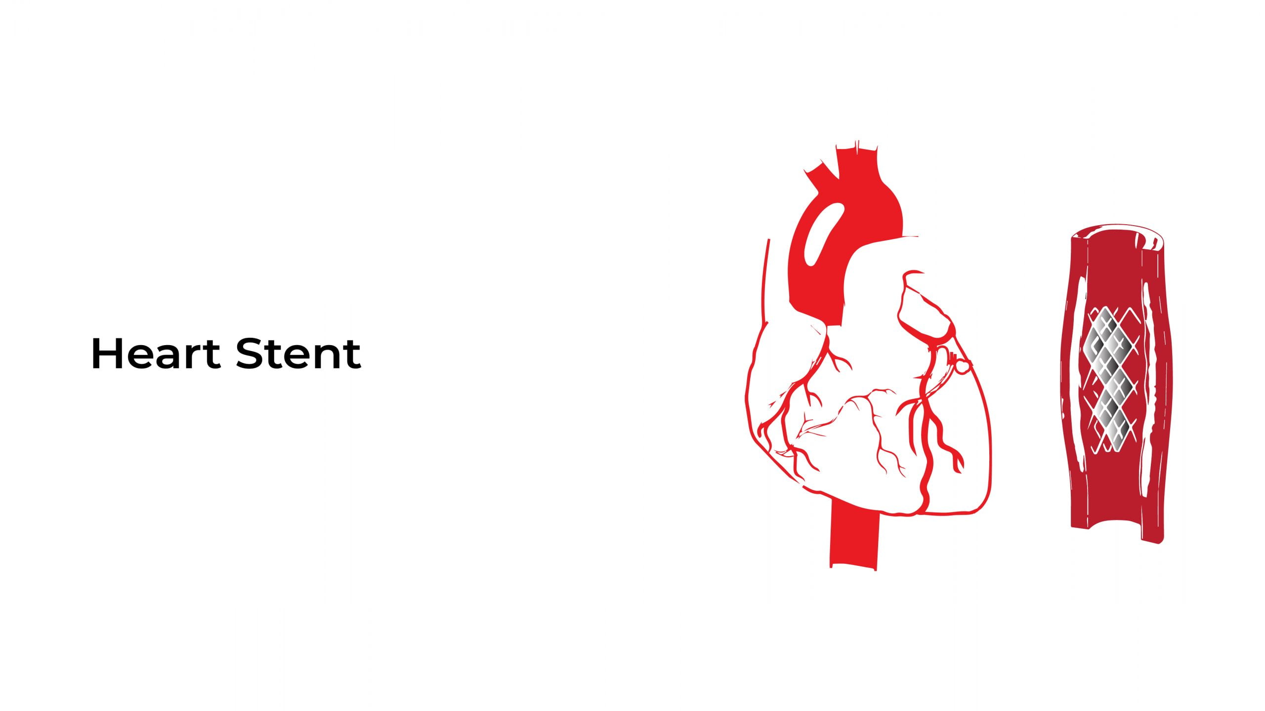 Heart Stent coronary angioplasty & balloon angioplasty